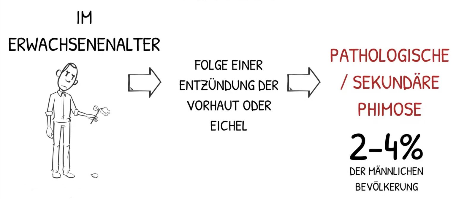 Phimose: Ursachen, Symptome, Behandlungen für Vorhautverengung