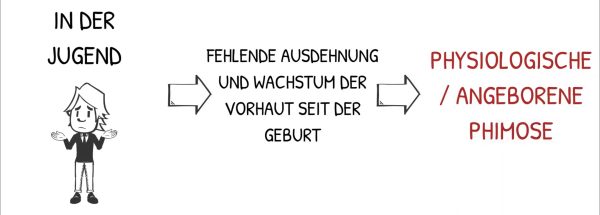 Phimose: Ursachen, Symptome, Behandlungen für Vorhautverengung